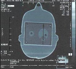 Head and Neck IMRT phantom