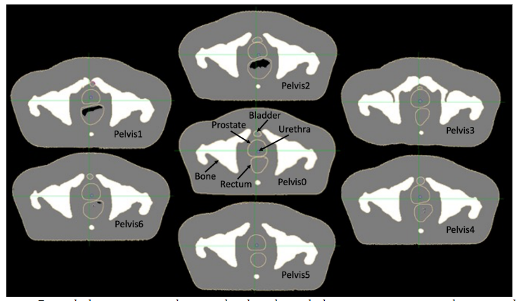 Figure: Digital phantom series showing the slice through the prostate ...